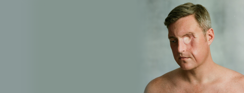 Living with Scars - The Scar Free Foundation