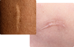 What is a Scar? - The Scar Free Foundation