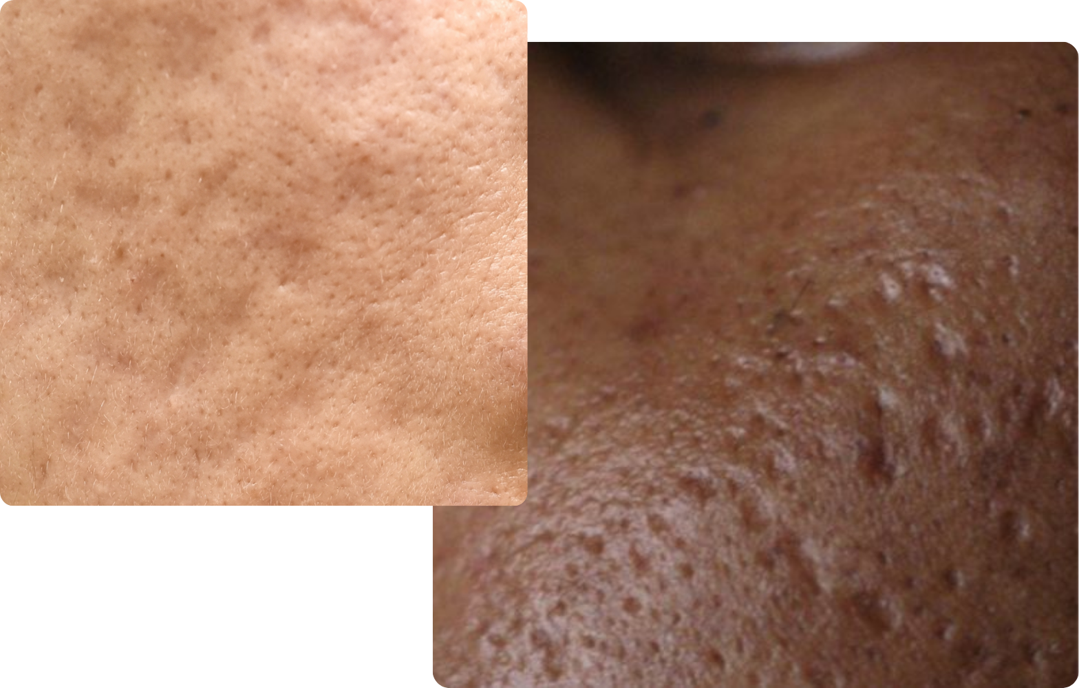 What is a Scar? - The Scar Free Foundation